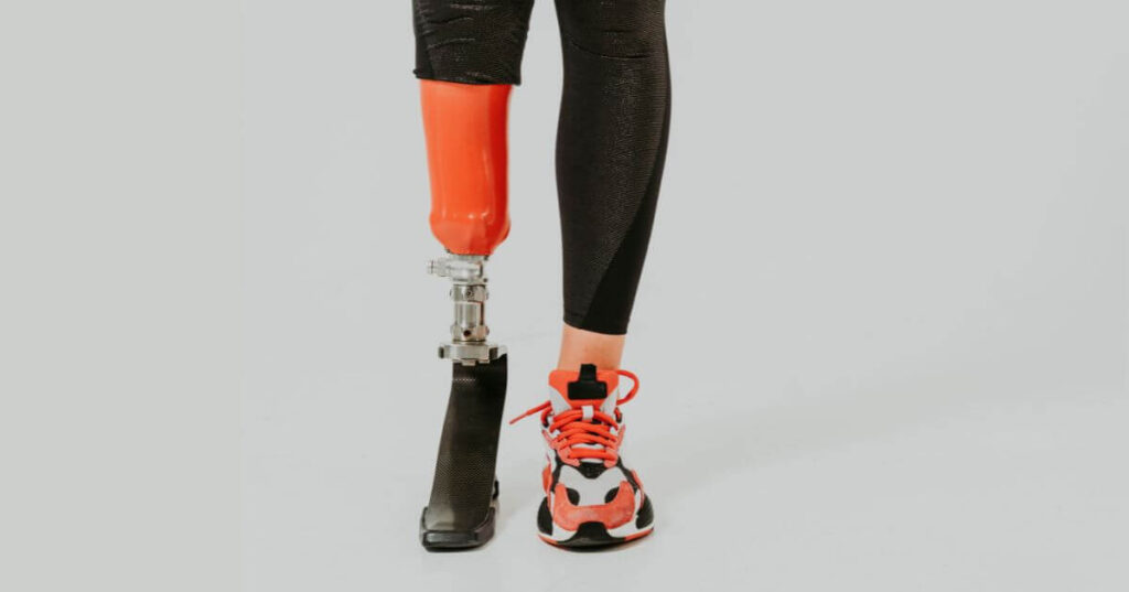 Syme Amputation Explained: The Ultimate Guide (2025)