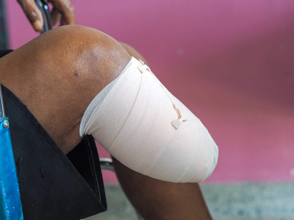 Analysis of Life Expectancy After a Leg Amputation