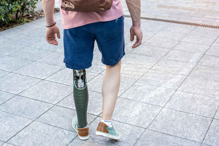 Analysis of Life Expectancy After a Leg Amputation