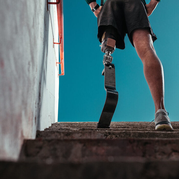 Everything You Need to Know About Prosthetic Leg