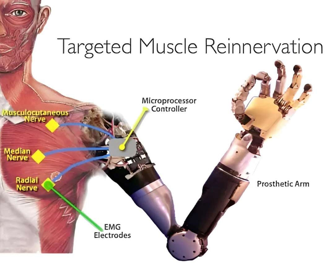 Everything You Need to Know About Myoelectric Prosthesis