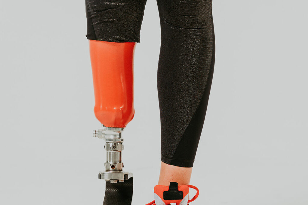 Prosthetic Socket Explained: Types, Fitting, and Challenges - Is Brave
