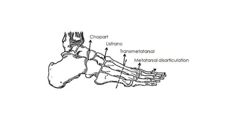 Partial Foot Prosthesis Guide: Benefits, Types, Care Tips & More