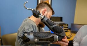 Above Elbow Prosthesis: What You Need to Know