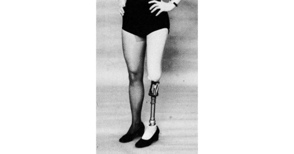 Knee Disarticulation Prosthesis: What You Need to Know - Is Brave