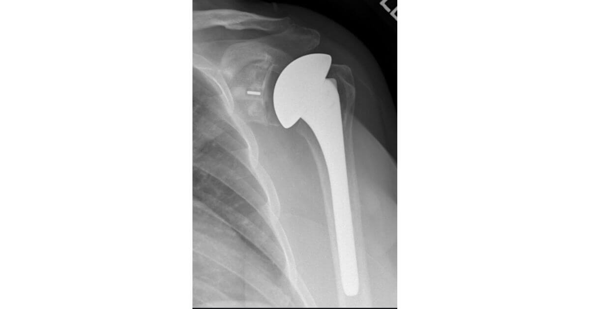 Shoulder Prosthesis: A Guide to Shoulder Replacement - Is Brave